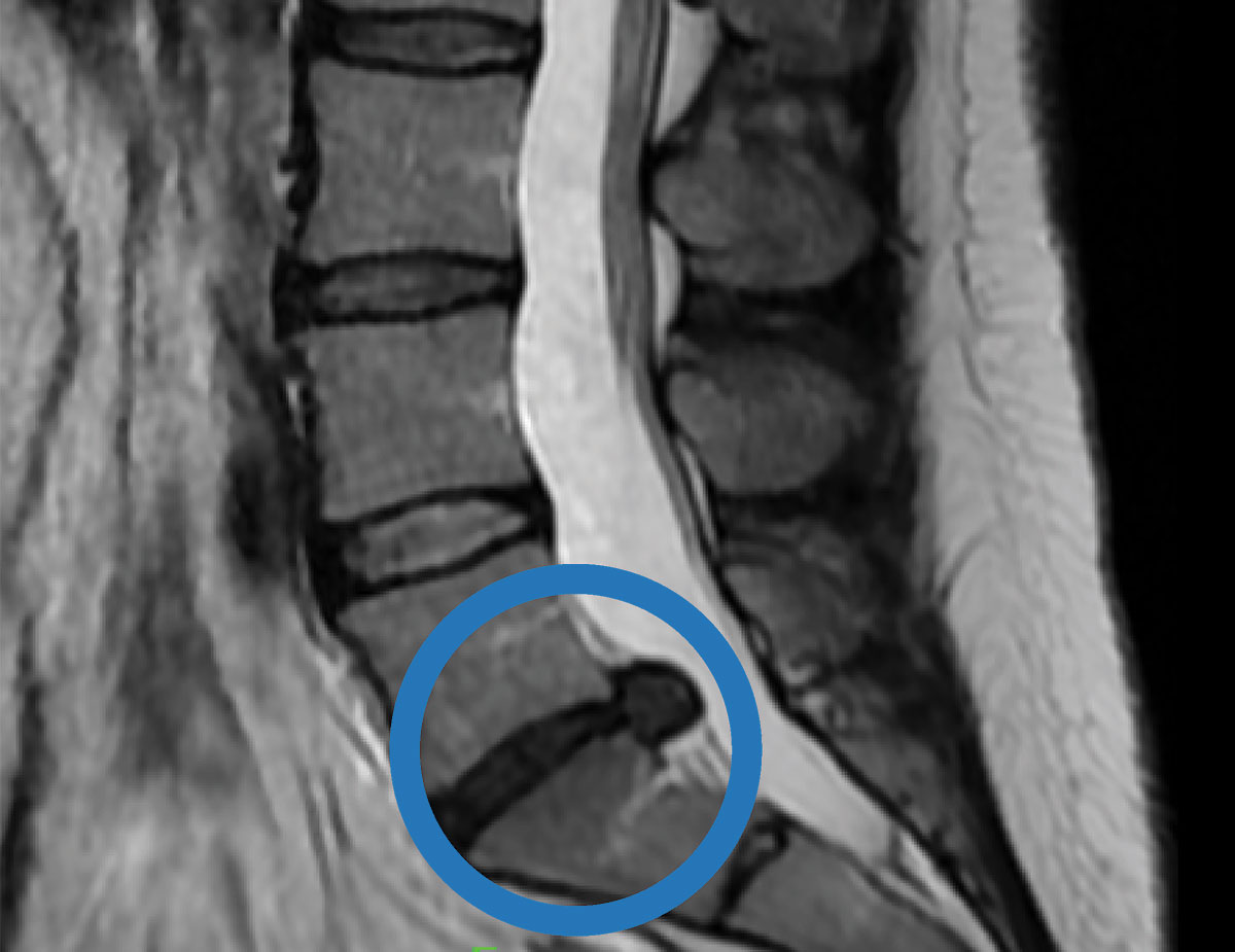 Disc Issues Treatment in Raleigh, NC | Active Chiropractic